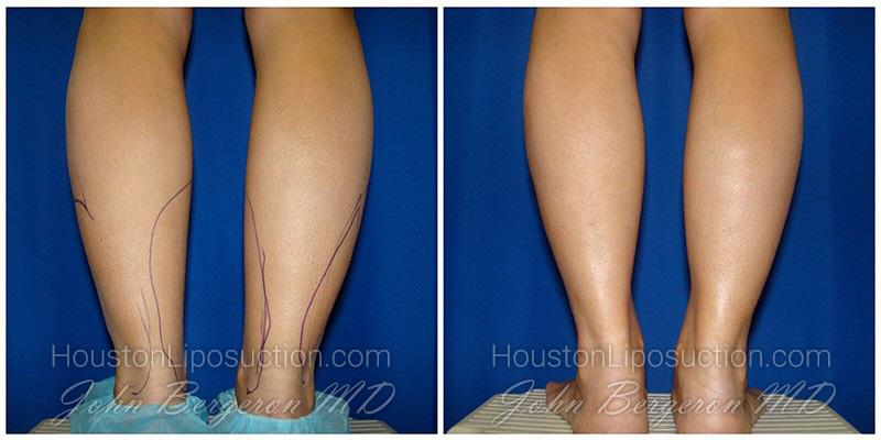 Calf and Ankle Liposuction / SmartLipo in Houston TX