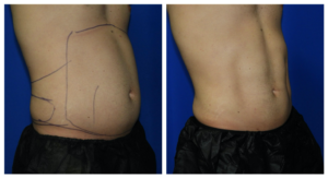 Five Things You Need to Know About Stomach Liposuction - Houston Lipo ...