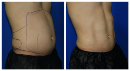 Five Things You Need to Know About Stomach Liposuction - Houston Lipo ...