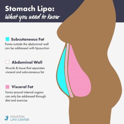 Can You Get a Flat Stomach with Liposuction? - Houston Lipo Center