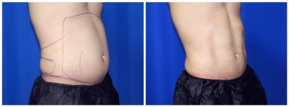 Top 3 Liposuction Areas for Men | Houston Lipo Center