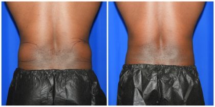 Top 3 Liposuction Areas for Men | Houston Lipo Center